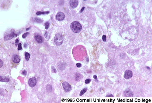 Councilman Body ( Or Acidophilic Body) gif by usmle | Photobucket